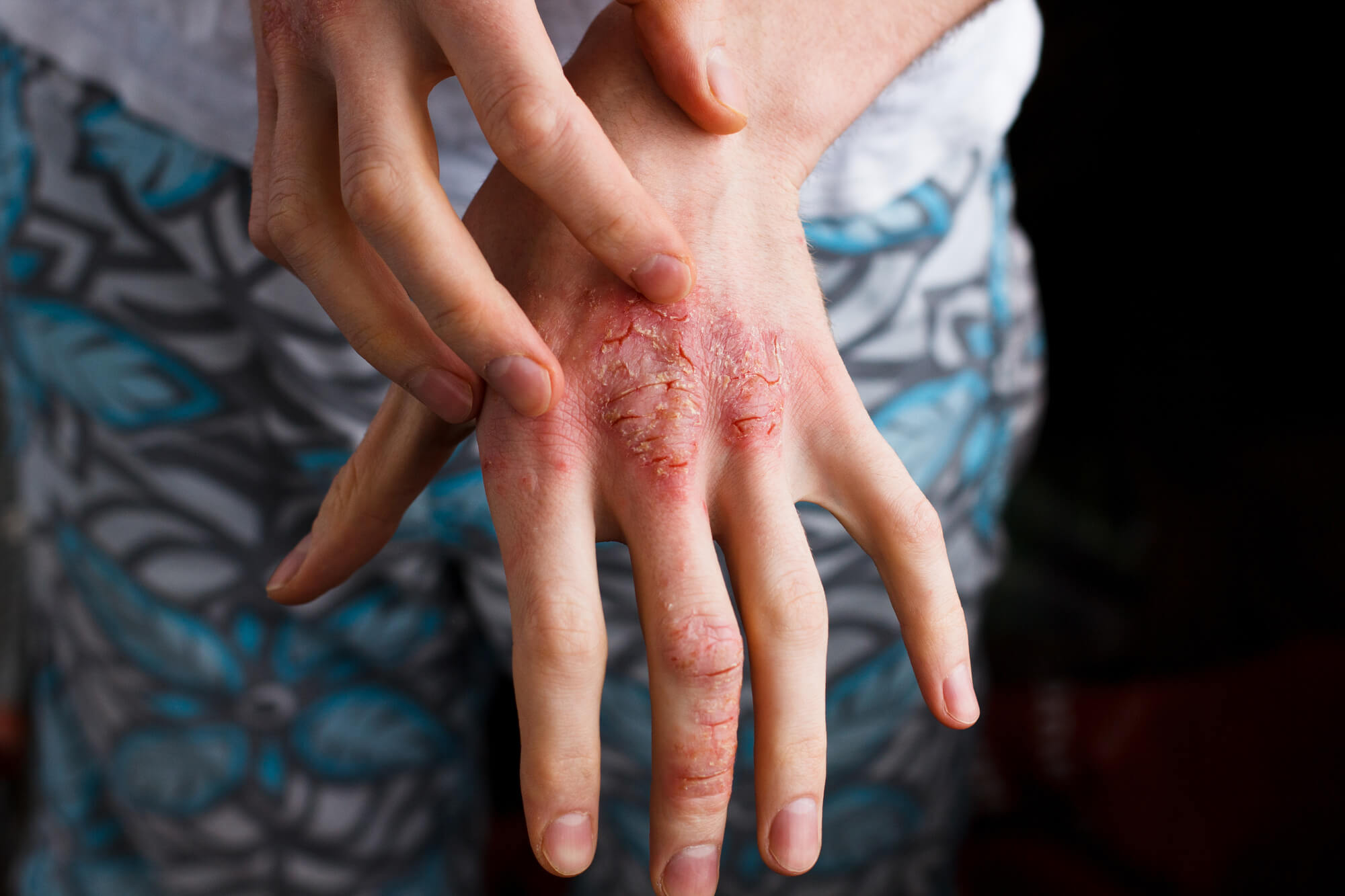 9 Ways smoking damages your skin - AA Clinic A & A Clinic - Science and ...